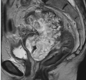 Pelvic Exenteration Surgery – Division of General Surgery Department of ...